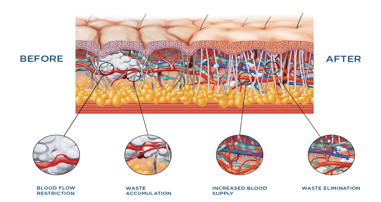 Cellutone - Skin Care Physicians