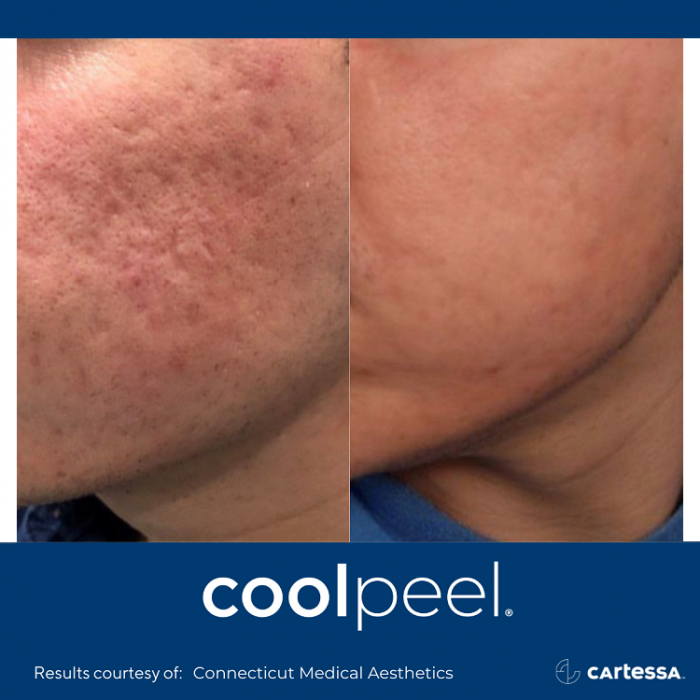 CoolPeel® | Laser Skin Care Technology In Georgia