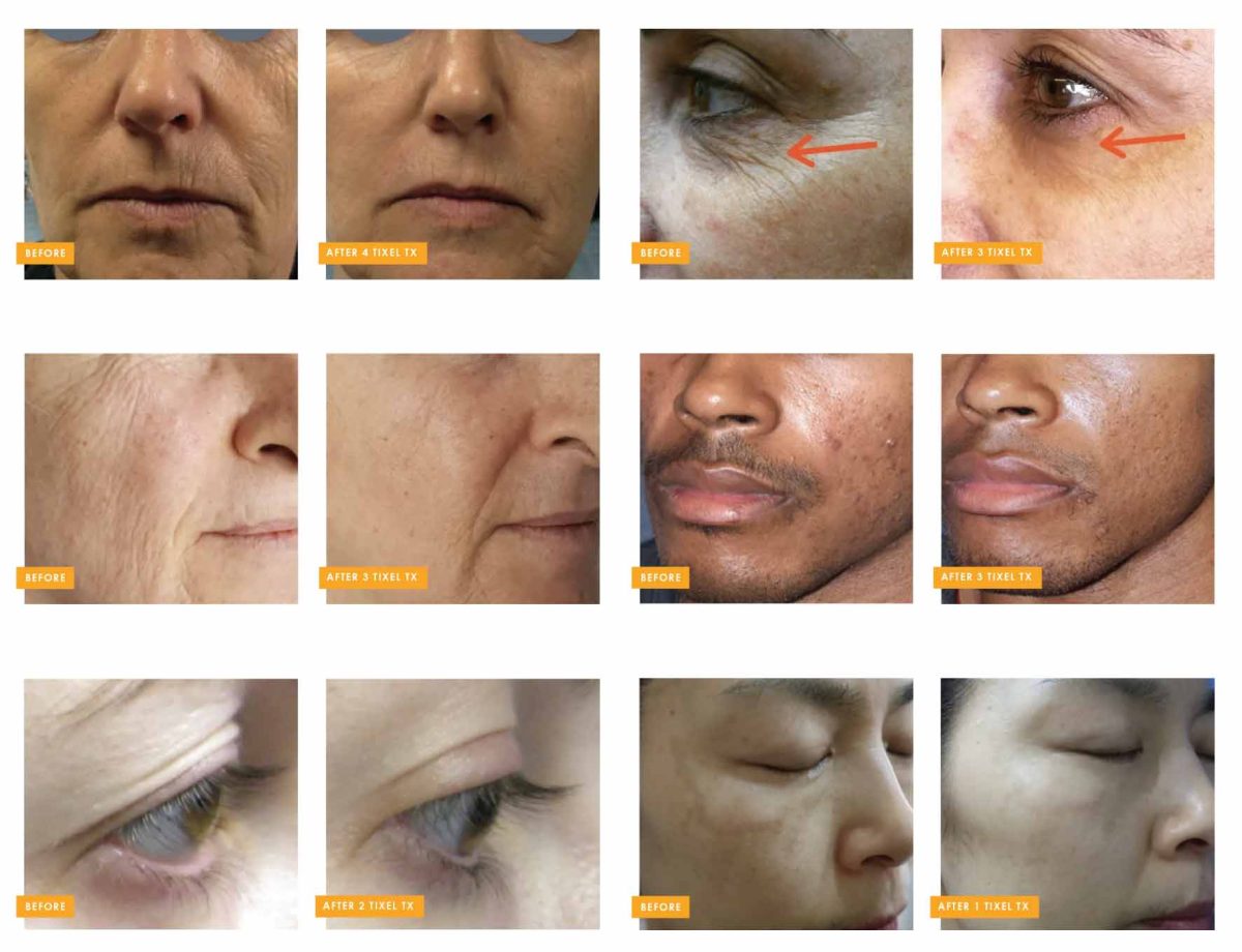 TIXEL® - Skin Care Physicians